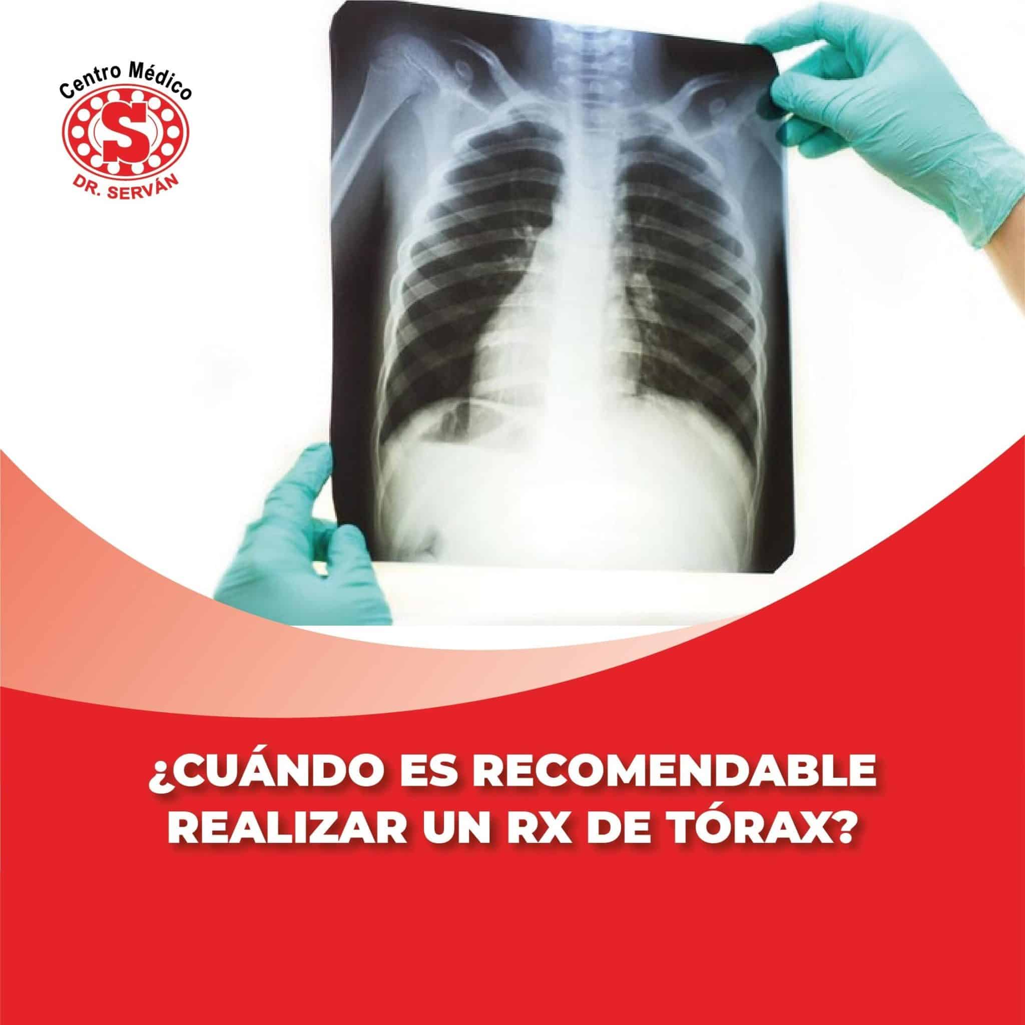 ¿Cuándo es recomendable realizar un Rx de Tórax? - Centro Médico Dr. Serván