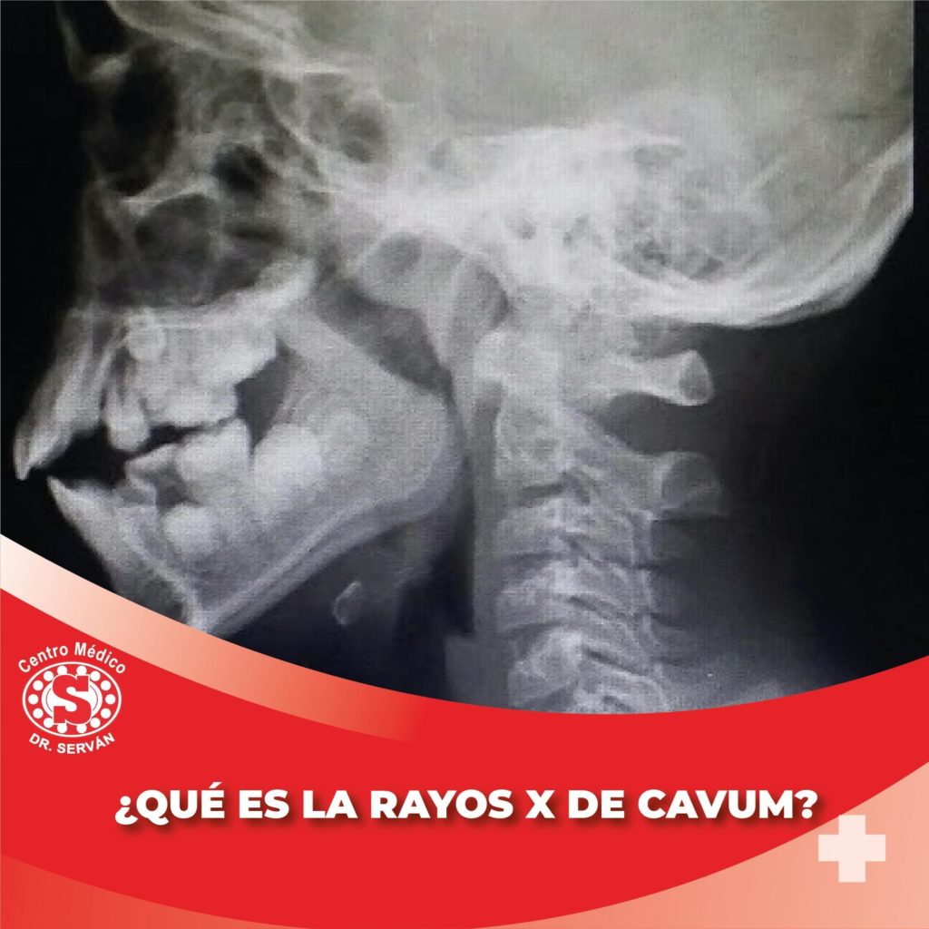 ¿Qué es la RX de Cavum? - Centro Médico Dr. Serván
